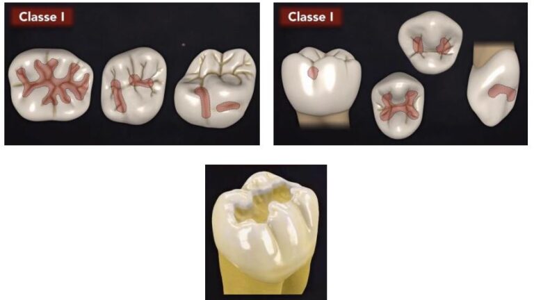 Classificação do preparo cavitário - Cursos Técnicos